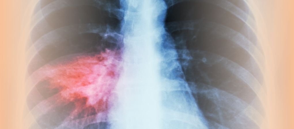Pneumonie - Osteopedia - le portail web mondial de l'ostéopathie