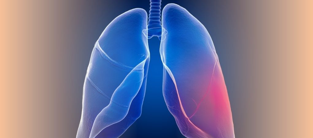 Fibrose kystique - Osteopedia - le portail web mondial de l'ostéopathie